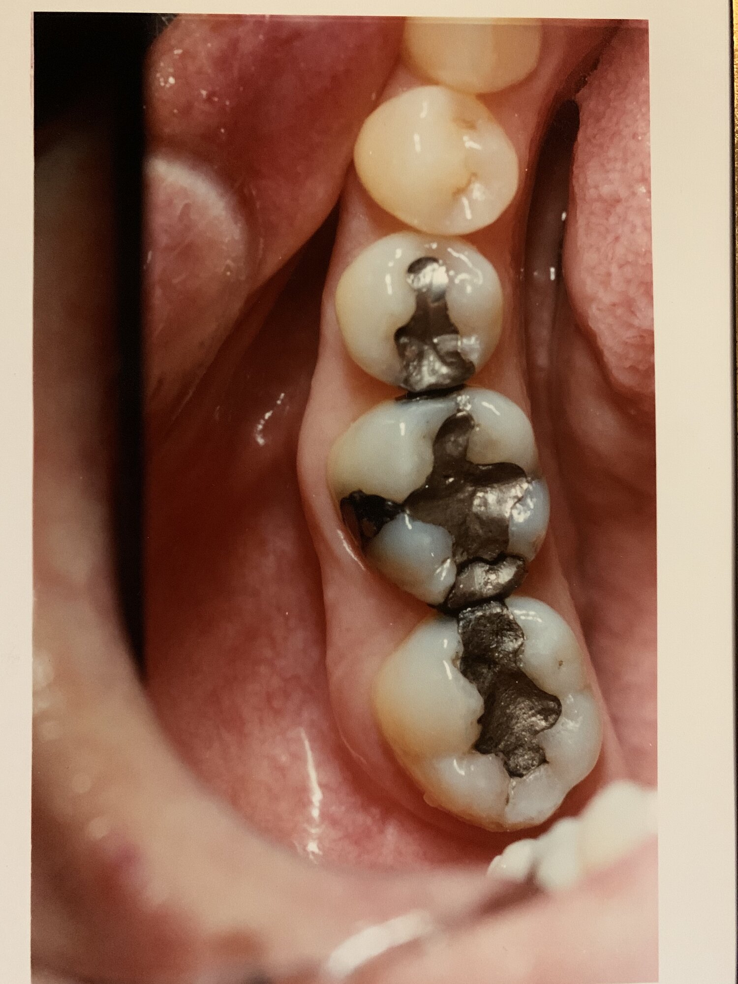 Fillings | Dental Emergency Services in Eureka, CA